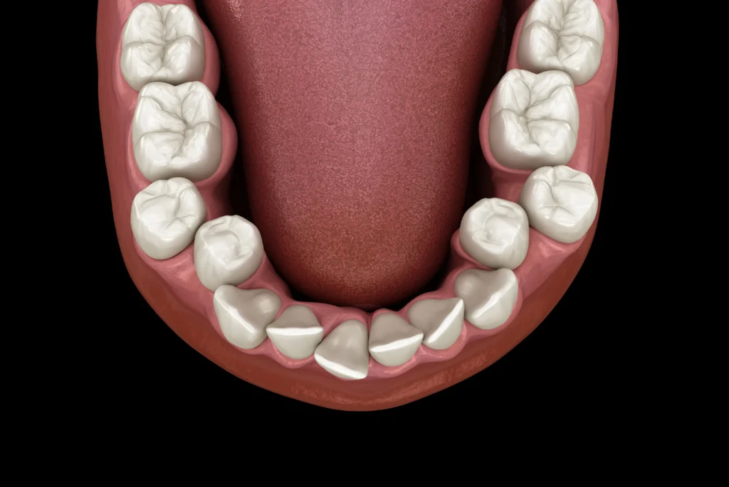 Understanding Dental Cross Bite: Causes, Effects, and Treatments - The ...