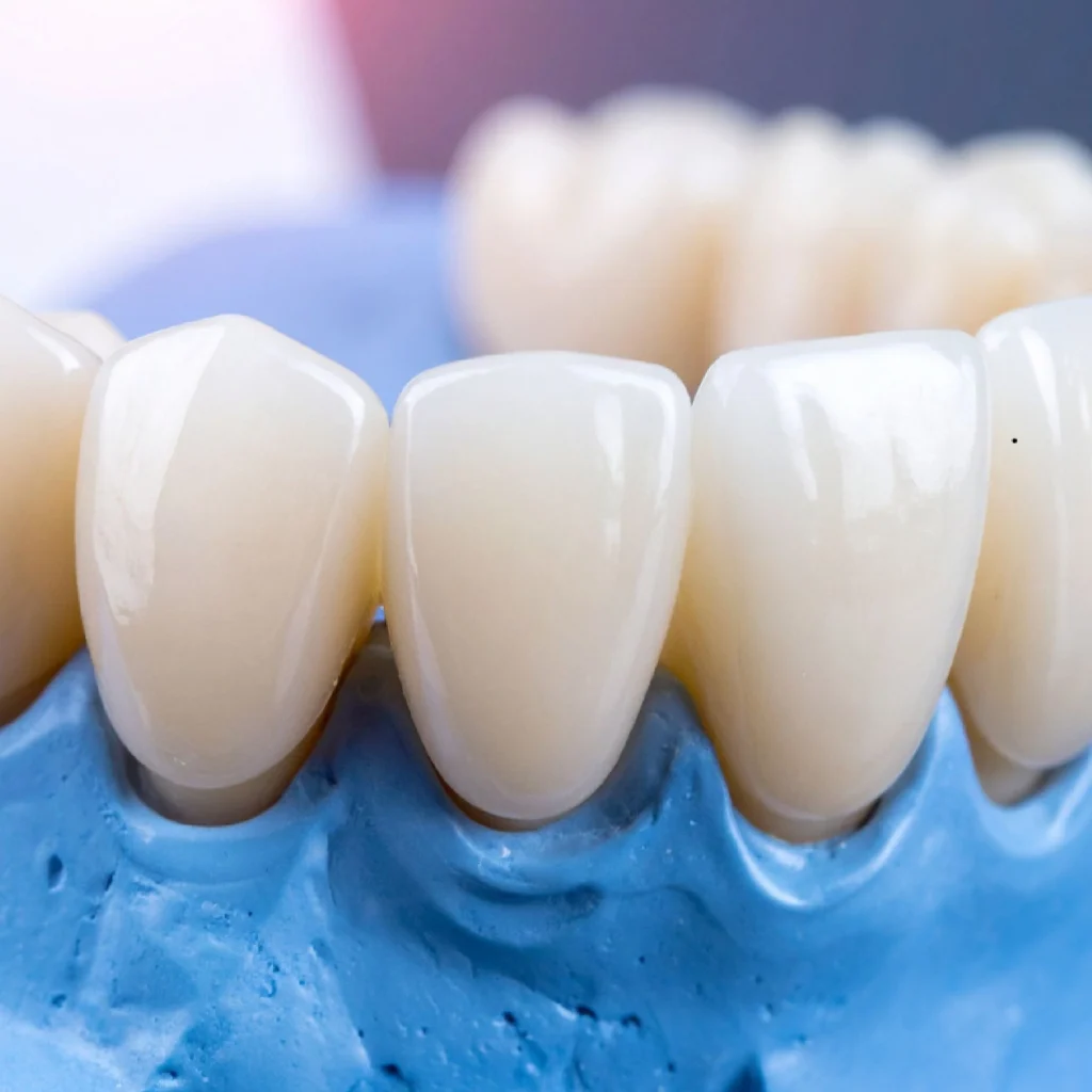 Bridge Crown Teeth: Bring Back Your Smile - The Grace Dental